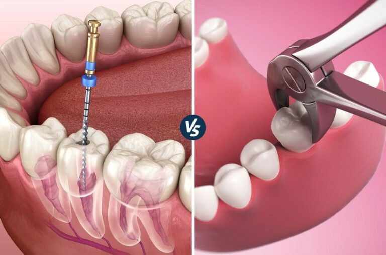 Bleeding After Tooth Extraction: Know How to Stop It